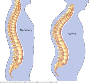 Apakah Kifosis Bisa Sembuh Total? - Gadjah Mada Orthopaedic Center ...